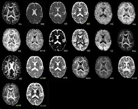 Diffusion Metrics From One Participant Dti Fa Fractional