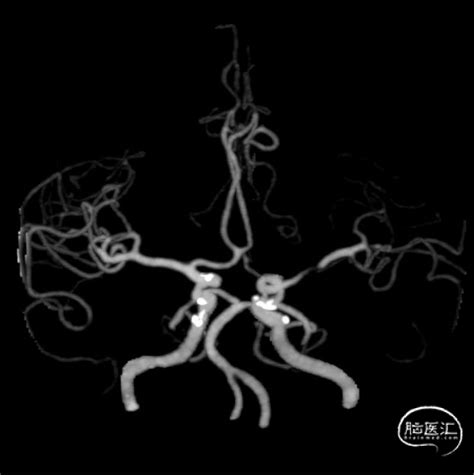 Atlas用于治疗颅内血管动脉粥样硬化性狭窄 脑医汇