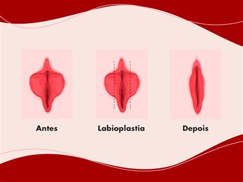 Labioplastia O guia completo da cirurgia de pequenos lábios