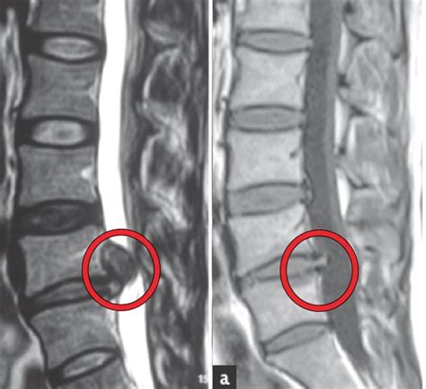 Herniated Disc Surgery Video