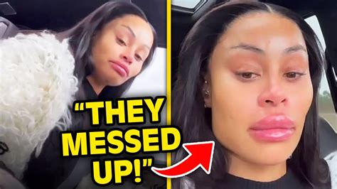 Botched Celebrity Plastic Surgery Transformations Before And After