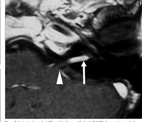Structure Of Retromandibular Vein Semantic Scholar