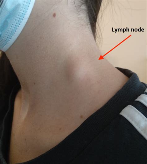 Chlamydia In Throat Pictures Symptoms Diagnosis Std Testing Near Me