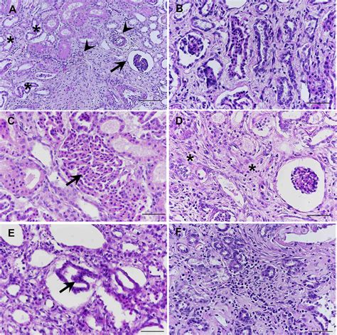 Ab The Interstitial Fibrosis Surrounding The Segmental Nephrons And