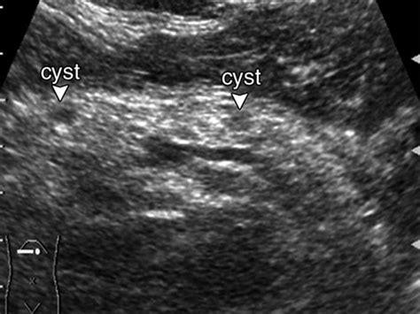 Pancreatic Duct Ultrasound