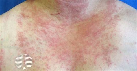 Spring Eruption Dermnet At Rachel Wand Blog