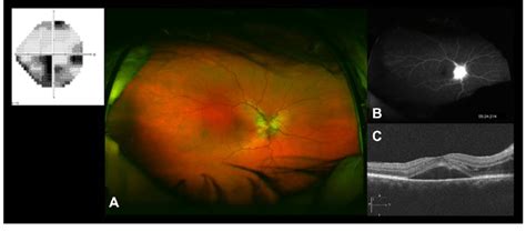 Optic Disk Involvement In Syphilitic Uveitis A With Papillitis Download Scientific Diagram