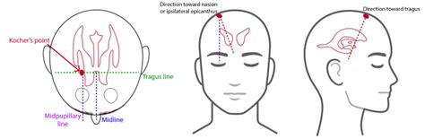 Critical Care Device Series External Ventricular Drain Emra
