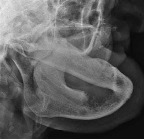 Squamous Cell Carcinoma Mandible Buyxraysonline