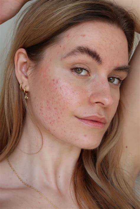 Accutane Before And After Artofit