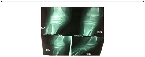 X Rays Showing Diffuse Demineralization With Knee Download Scientific Diagram