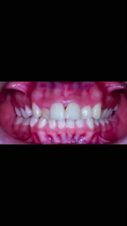 Asif Khan On Linkedin Dental Class Ii Correction With Upper 5s