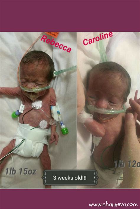 Mono Mono Twins Caroline And Rebeccas Story Shann Evas Blog