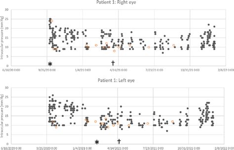 Solid Dots Represent Icare Home Intraocular Pressure Iop