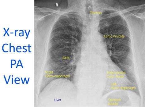 Aortic Knuckle All About Cardiovascular System And Disorders