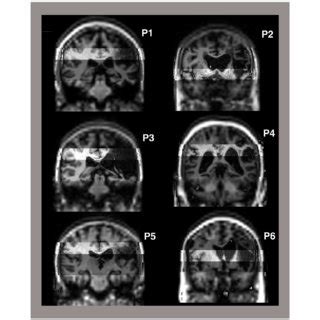Top Composite Coronal Slices One For Each Of The Six Patients Built Download Scientific