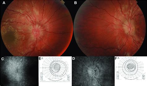 Optic Disc Elevation At Scarlett Tenison Woods Blog