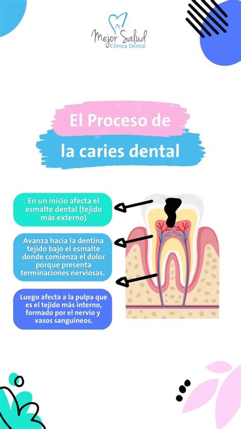 😢el Proceso De La Caries Dental 😖la Caries Es Una De Las Principales