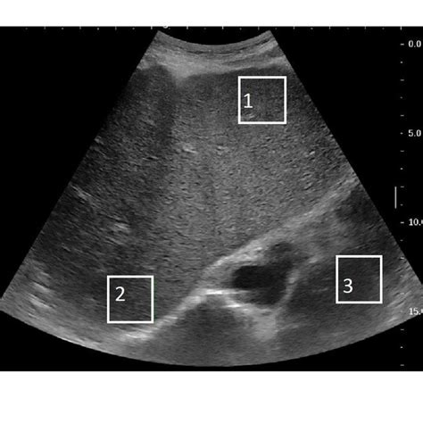 Pdf Multi Output Speckle Reduction Filter For Ultrasound Medical Images Based On
