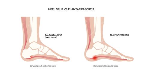 Premium Vector Calcaneal Spur And Plantar Fasciitis Comparison Foot