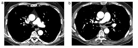 Photon Counting Computed Tomography Eleven Takeaways From A New
