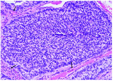 The Papillary Carcinoma Trabecular Subtype Does Not Show Any Papillary