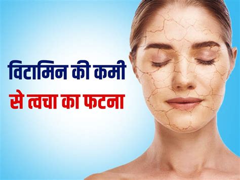 इस विटामिन की कमी से सर्दियों में ज्यादा फट सकती है आपकी स्किन जानें