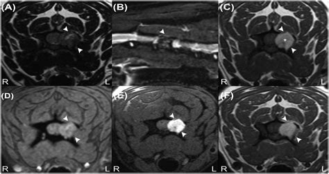 Transverse T2w Image A Sagittal Stir Image B Transverse