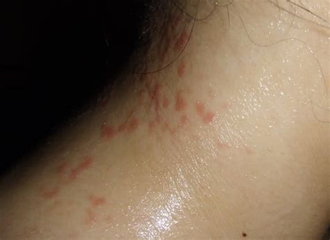 Itchy Rash On Upper Chest