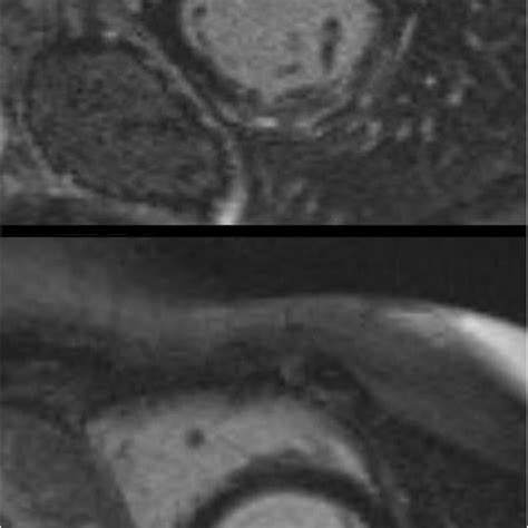 Diffuse Myocardial Fibrosis Short Axis View Inversion Recovery