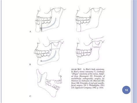 Mandibular Orthognathic Surgeries Ppt