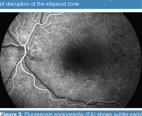 Figure 3 From Multiple Evanescent White Dot Syndrome Associated With