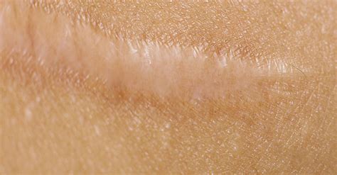 Keloid Scar Treatment Laser Treatment And Hypertrophic Scar Flattening Options Glamour UK