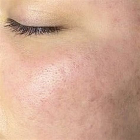 Biorepeel Dermatologist In Lake Forest Ca Saddleback Dermatology