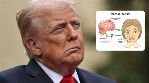 Roya News Did Donald Trump Have A Stroke