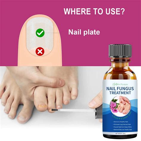Extra Strength Toenail Fungus Treatment Nail Repair Solution For