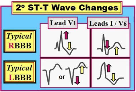 Lbbb Vs Rbbb Mnemonic Rhysecvelasquez