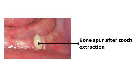 Why Is Jaw Bone Exposed After Tooth Extraction