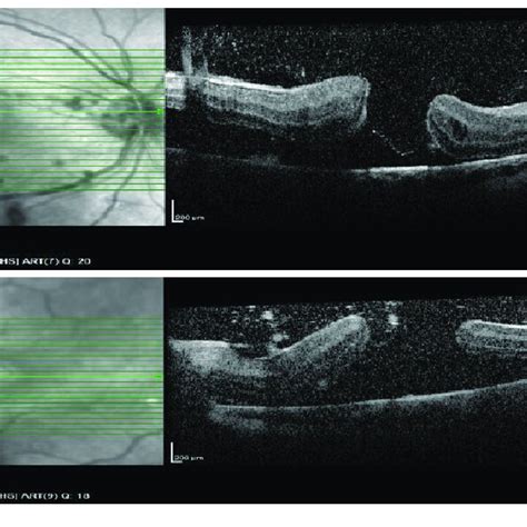 Macular Oct After Two Weeks Follow Up Showing Thick Erm Covering