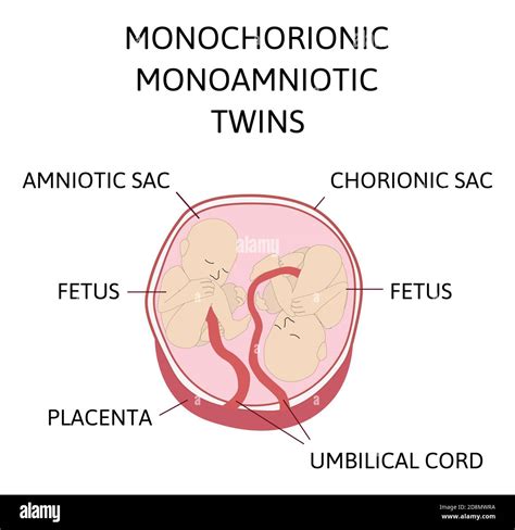 Anatomy Of Abdomen With Twins Twin Types Infographic Elements In Flat