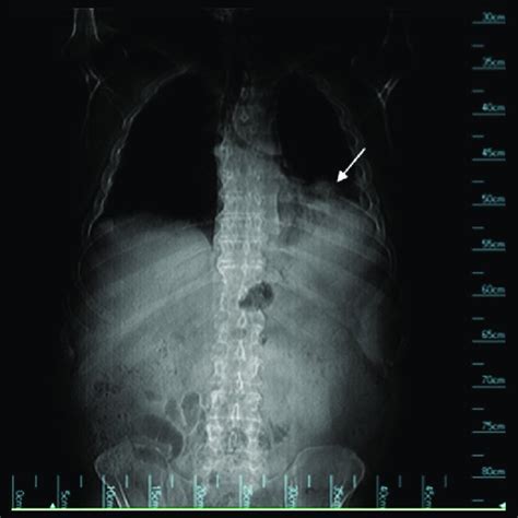 Pdf Spindle Cell Sarcoma Of The Paraspinal Musculature With Late Pulmonary Metastases