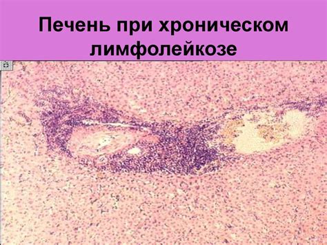 Патология клеток крови и костного мозга Опухоли из гемопоэтических тканей Болезнь Ходжкина