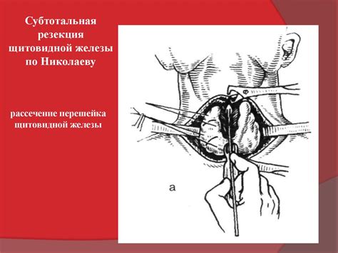 Операции на щитовидной железе презентация онлайн