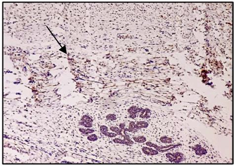 Ihc Showing Immunoreactivity For Desmin Arrow H Ande 40x Download