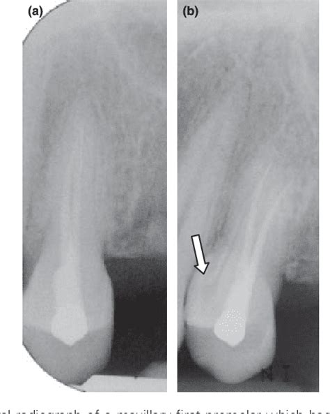 Figure 5 From Dens Invaginatus Part 2 Clinical Radiographic Features