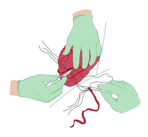 Heart Bypass Surgery Photograph By Jeanette Engqvist Fine Art America