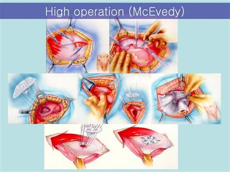 Femoral Hernia Ppt