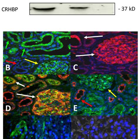 Crhbp Protein Expression And Tissue Localization In Cc Rcc And Normal