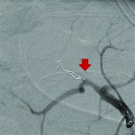 Angiography Of Right Inferior Phrenic Artery The Collateral Hepatic