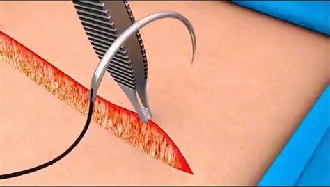 The Innovation Medicine On Twitter Vertical Mattress Sutures Innov